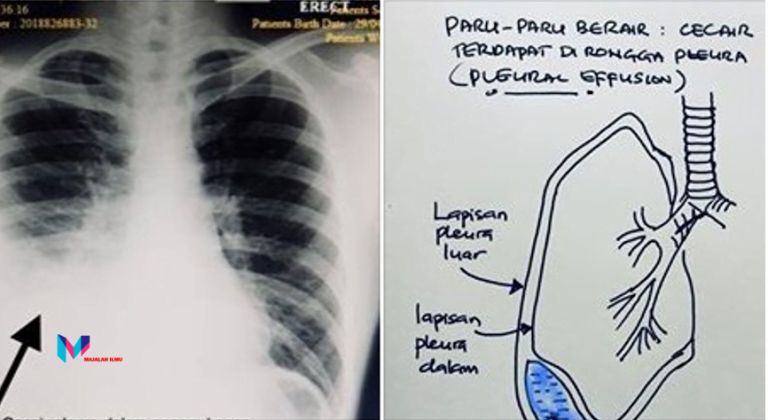 Paru-paru berair sebab mandi malam? Baca ulasan doktor pakar. - Majalah ...